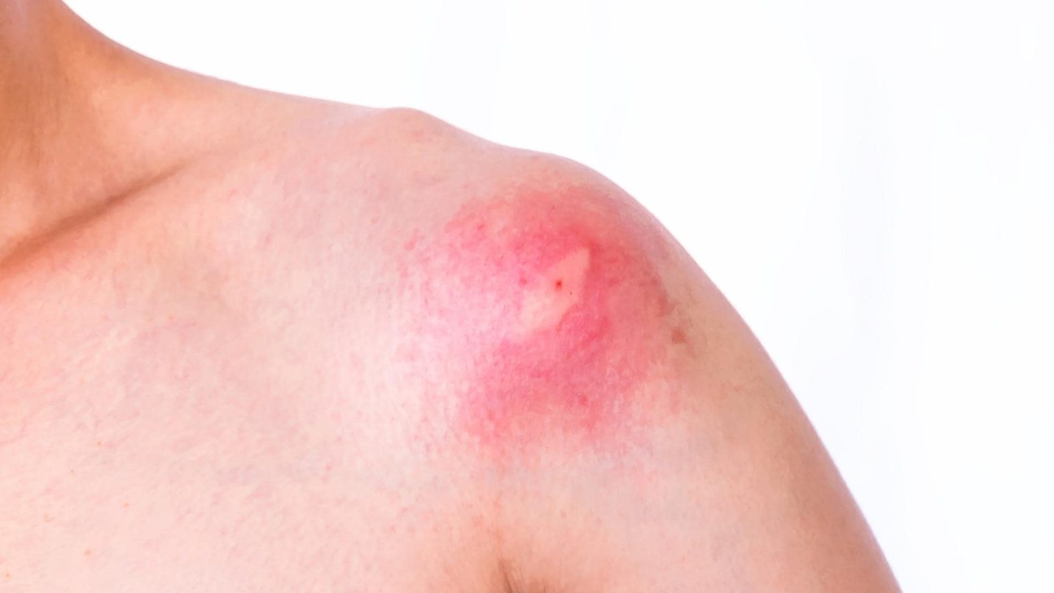 First Aid for Insect Bites and Stings | Coast2Coast