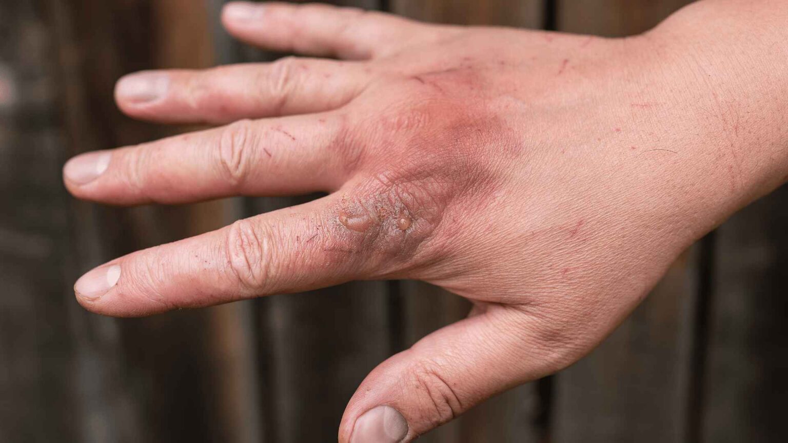 First Aid for Electric Burns | Coast2Coast